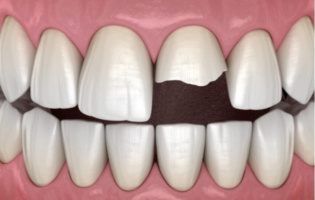 Why Does A Damaged Tooth Need To Be Treated, And How Do Crowns Help?